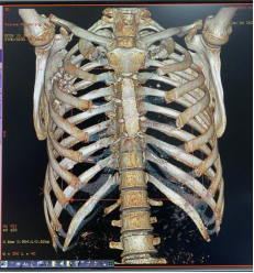 【影像科普】CT检查中的三维重建是什么检查？ - 犍为县中医医院